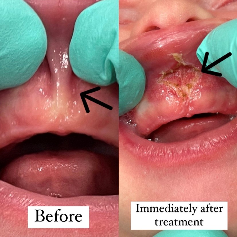 Tongue & Lip Tie Gallery ⋆ Belpre Dental Studio®