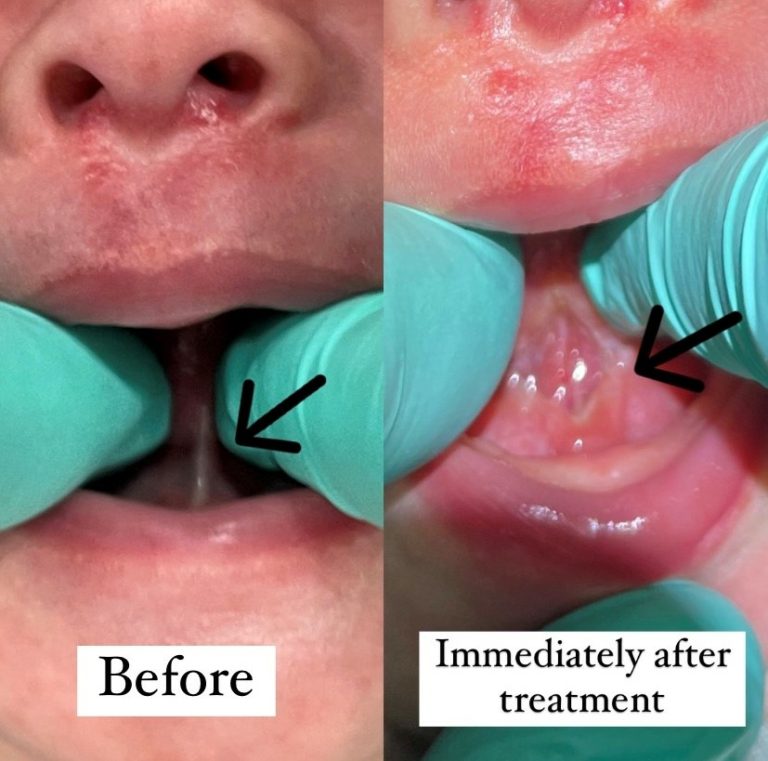 Tongue & Lip Tie Gallery ⋆ Belpre Dental Studio®