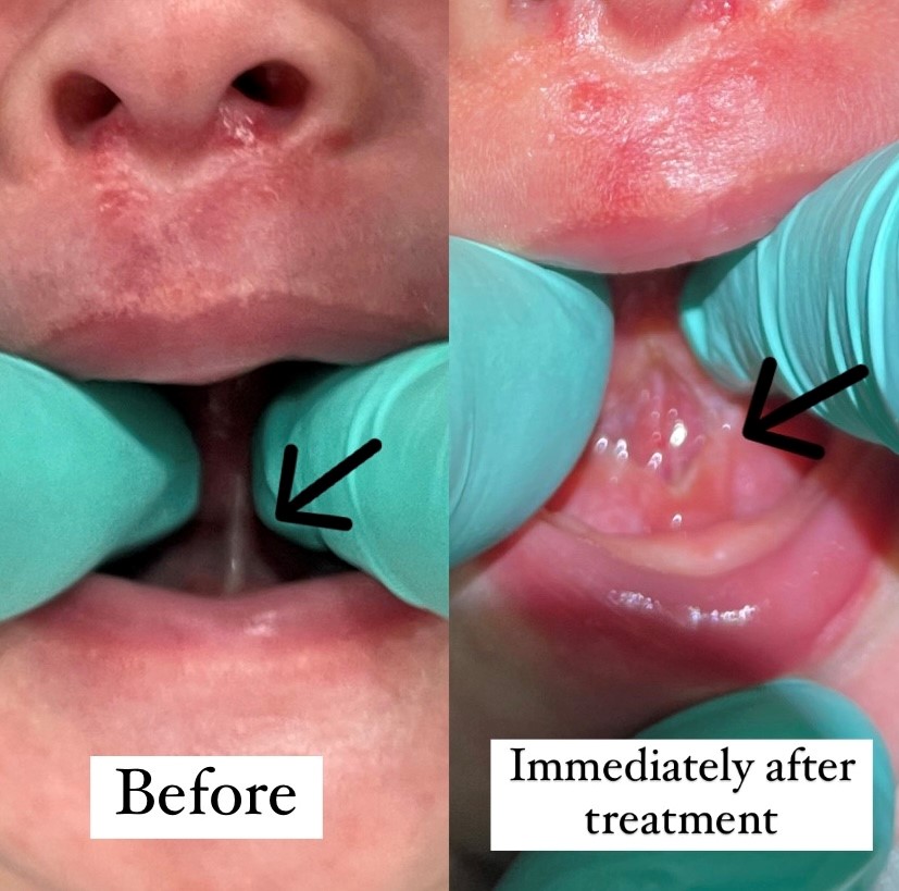 Tongue & Lip Tie Gallery ⋆ Belpre Dental Studio®