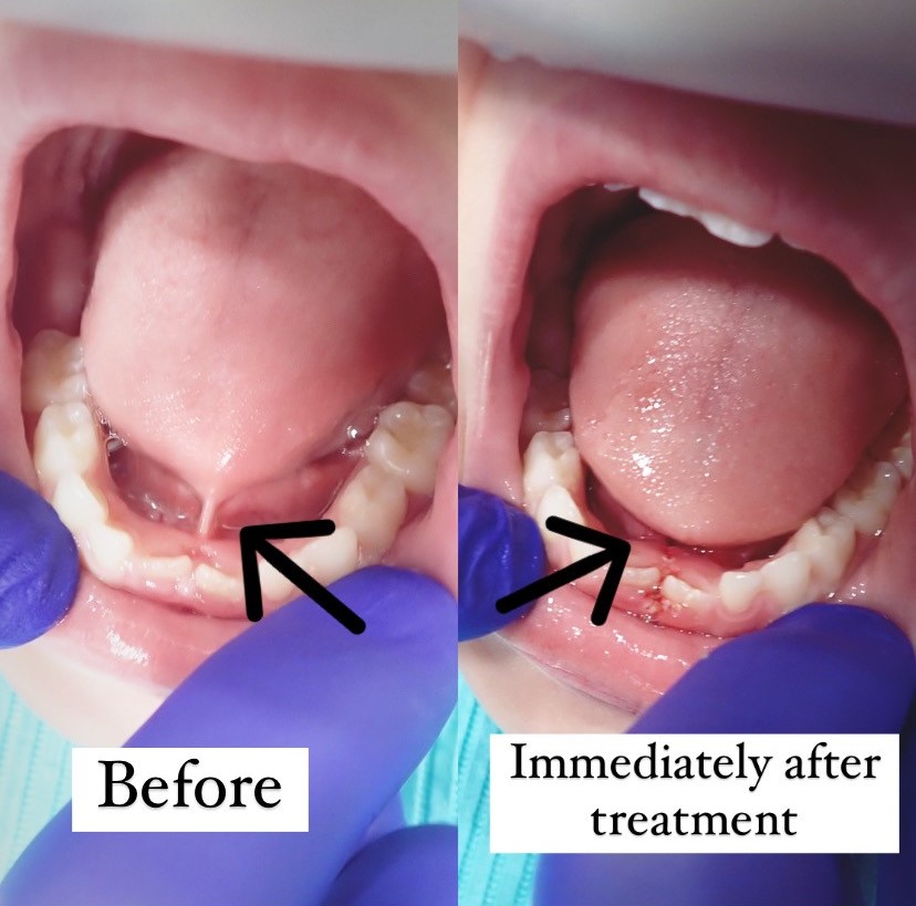 Tongue & Lip Tie Gallery ⋆ Belpre Dental Studio®