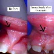 Tongue & Lip Tie Gallery ⋆ Belpre Dental Studio®