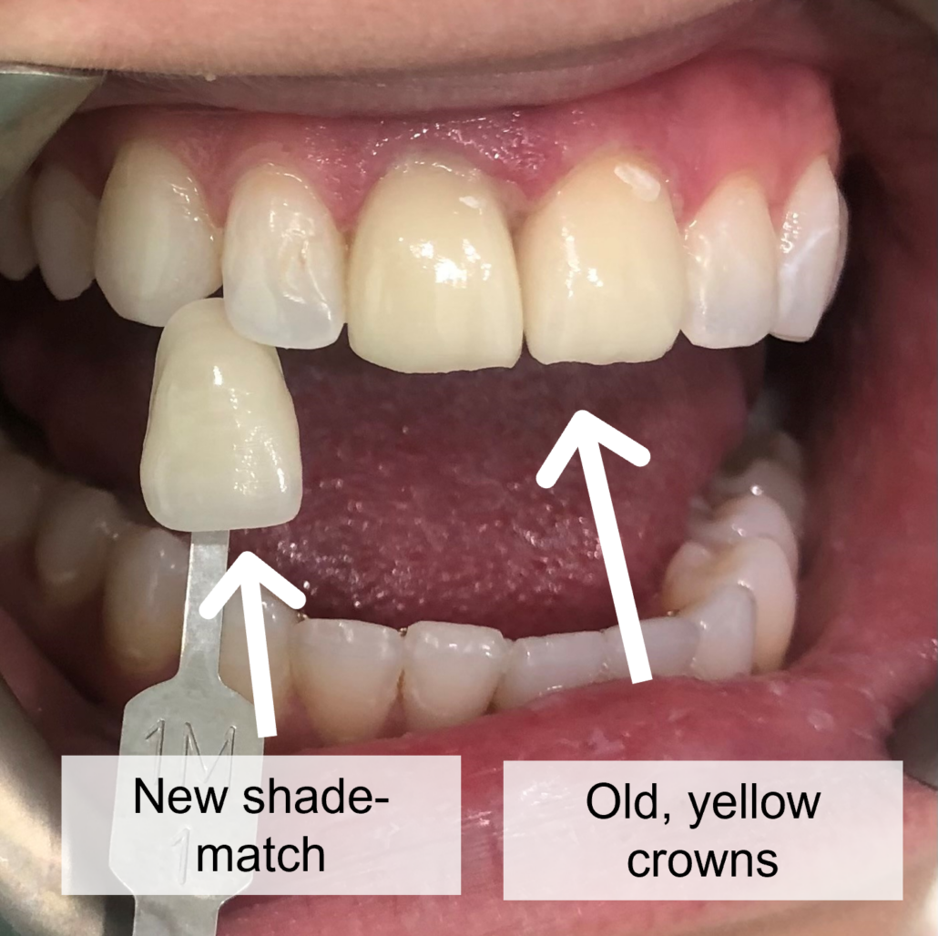 Before & After Smile Gallery ⋆ Belpre Dental Studio®