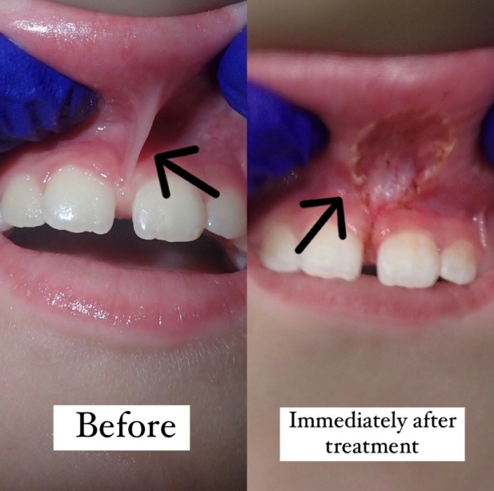 Tongue & Lip Tie Gallery ⋆ Belpre Dental Studio®