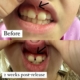 Tongue & Lip Tie Gallery ⋆ Belpre Dental Studio®