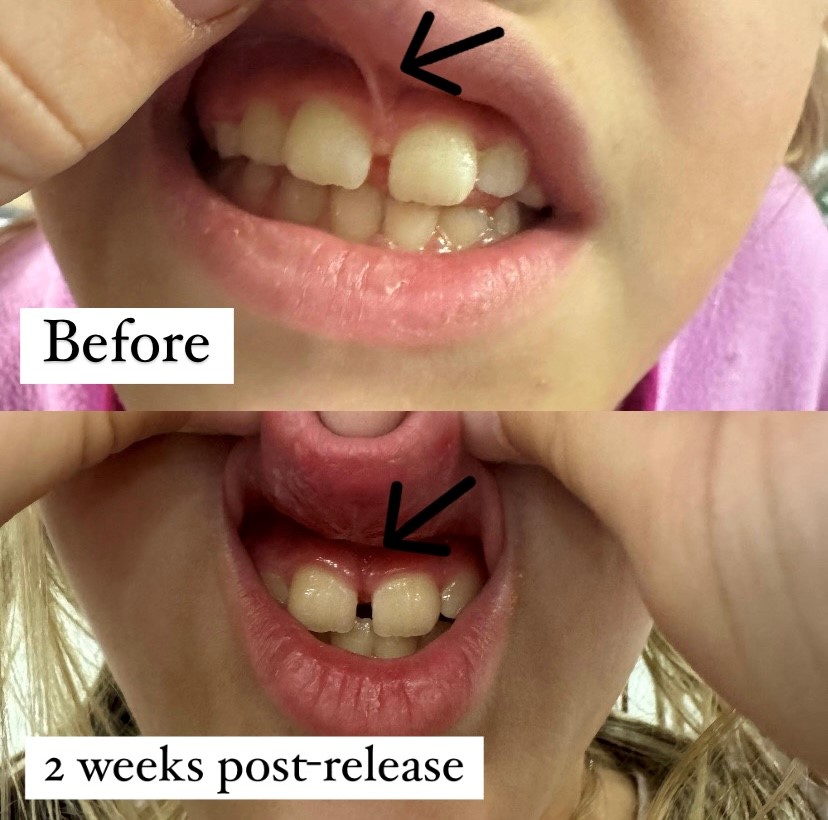 Tongue & Lip Tie Gallery ⋆ Belpre Dental Studio®