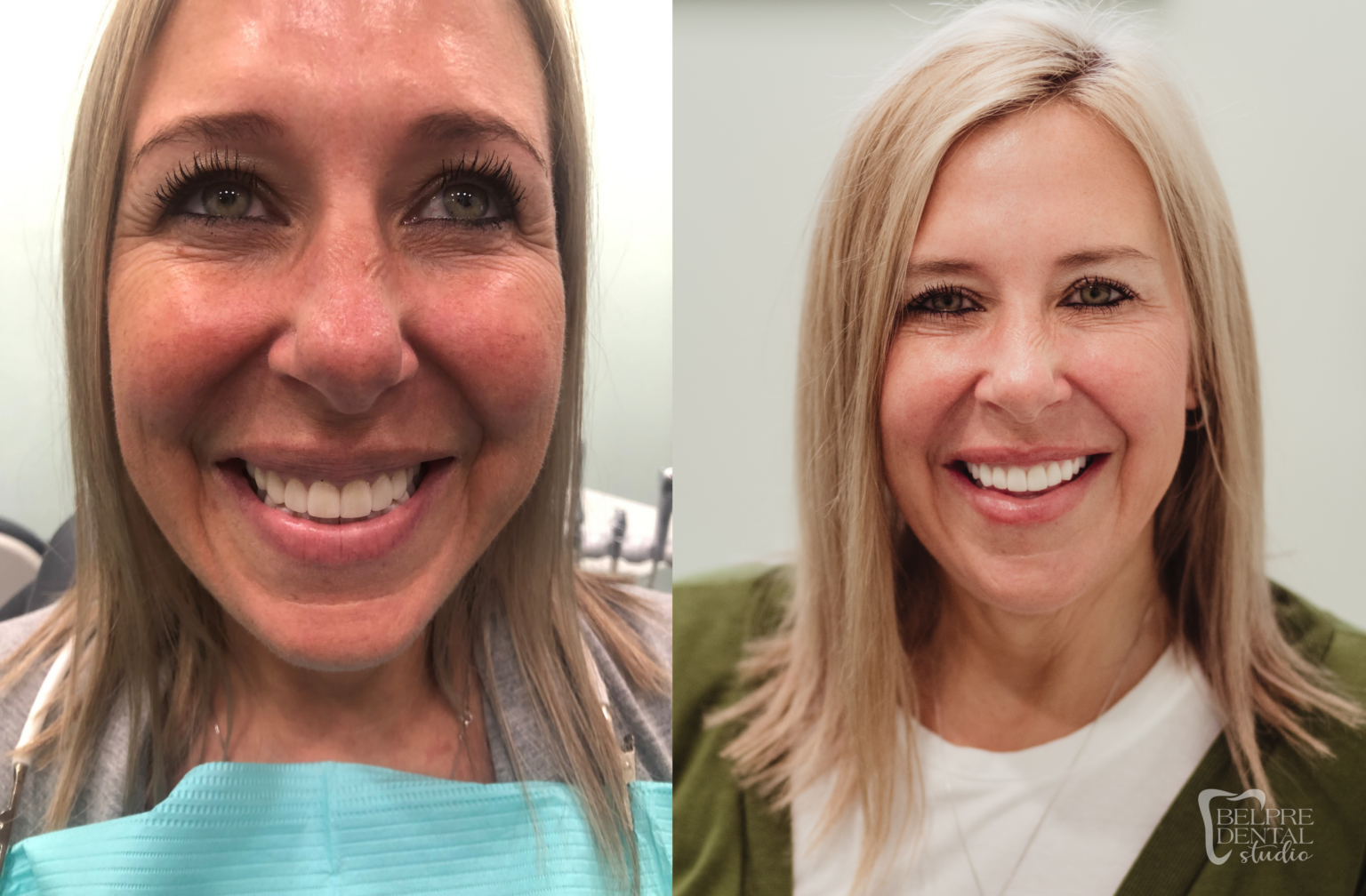 Before & After Smile Gallery ⋆ Belpre Dental Studio®
