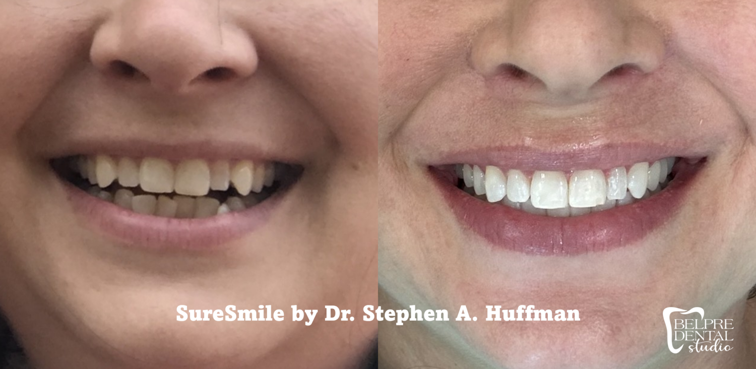 SureSmile Clear Aligners ⋆ Belpre Dental Studio®