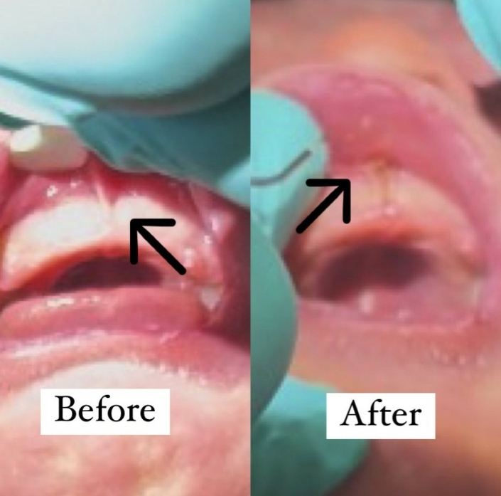 Tongue & Lip Tie Gallery ⋆ Belpre Dental Studio®