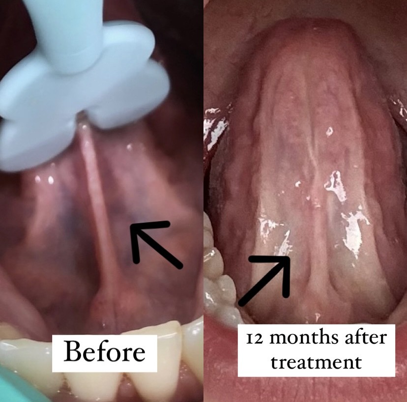 Tongue & Lip Tie Gallery ⋆ Belpre Dental Studio®