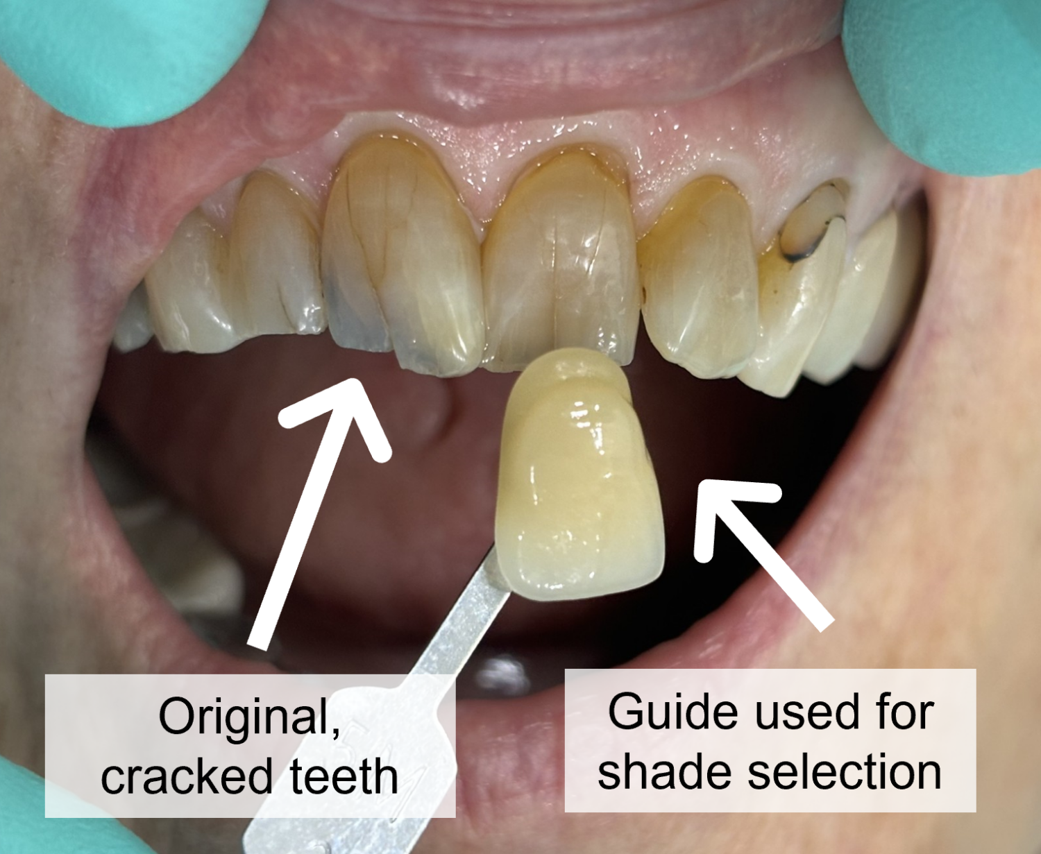 Before & After Smile Gallery ⋆ Belpre Dental Studio®