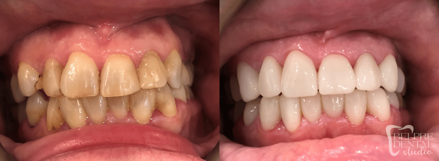 Before & After Smile Gallery ⋆ Belpre Dental Studio®
