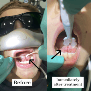 Tongue & Lip Tie Gallery ⋆ Belpre Dental Studio®