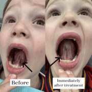 Tongue & Lip Tie Gallery ⋆ Belpre Dental Studio®