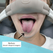 Tongue & Lip Tie Gallery ⋆ Belpre Dental Studio®