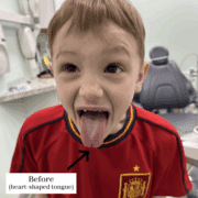 Tongue & Lip Tie Gallery ⋆ Belpre Dental Studio®