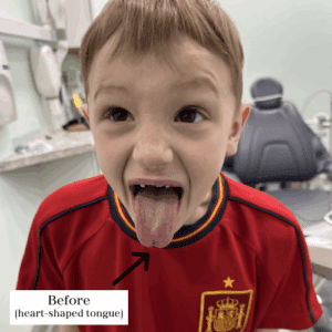 Tongue & Lip Tie Gallery ⋆ Belpre Dental Studio®